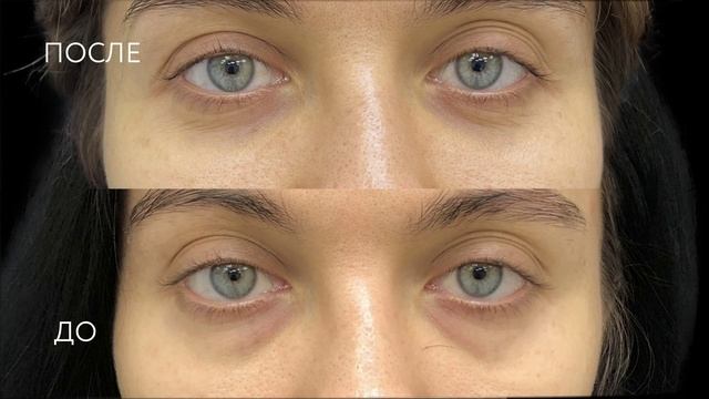 До и после нижней трансконъюнктивальной блефаропластики