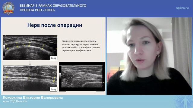 Онлайн-лекция СПРО "Нетипичные проявления туннельных невропатий при ультразвуковом исследовании"