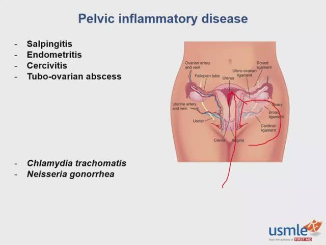 USMLE RX - 7.Микробиология - 6.Общее - 2.Воспалительные Заболевания Органов Малого Таза