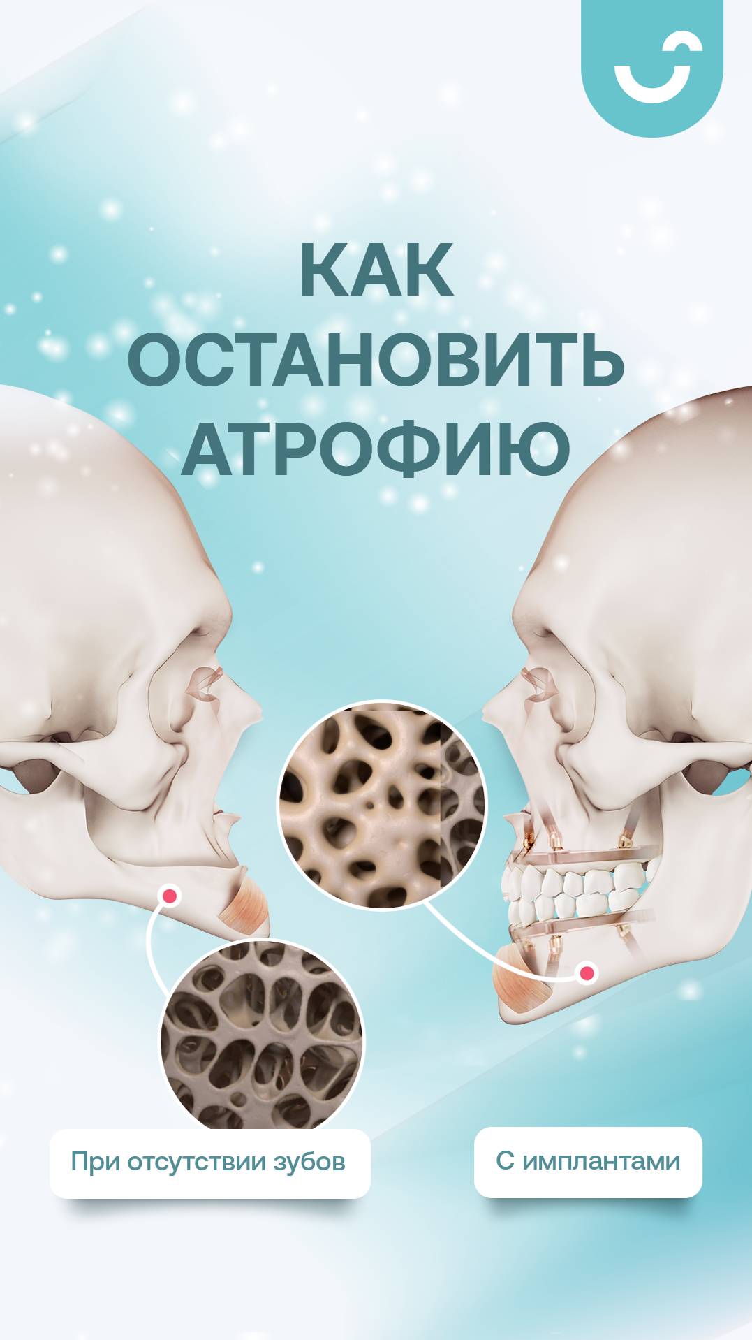 Как импланты влияют на костную ткань ичто поможет остановить атрофию?