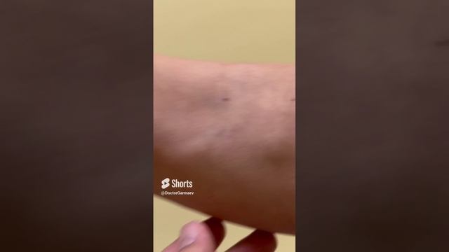 ✅ Липоматоз. Множественные липомы на руках