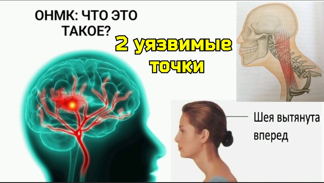 Спазм позвоночной артерии - причина инсульта мозга. Роль мышц шеи: нижней косой, передней лестничной
