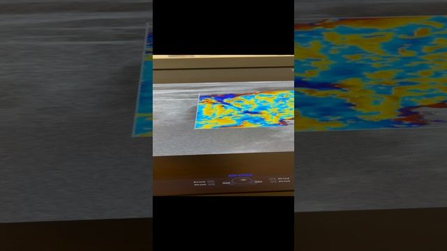 Массивный варикоз на узи. Узи сосудов. Флеболог. Флеболог Москва