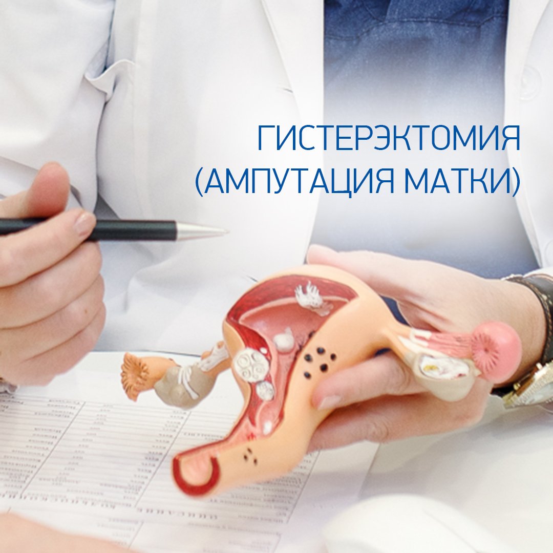 Ампутация матки