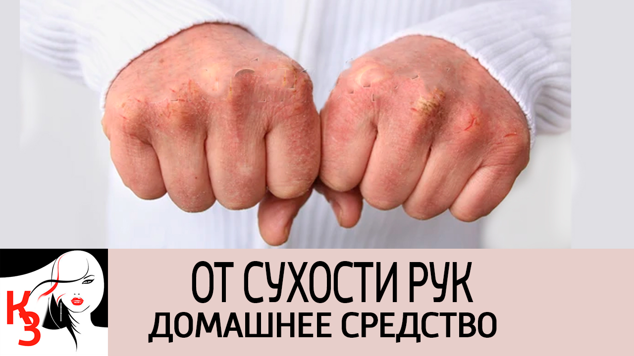 Маска для рук - сметана и календула. Быстрое избавление от сухости и морщин на руках